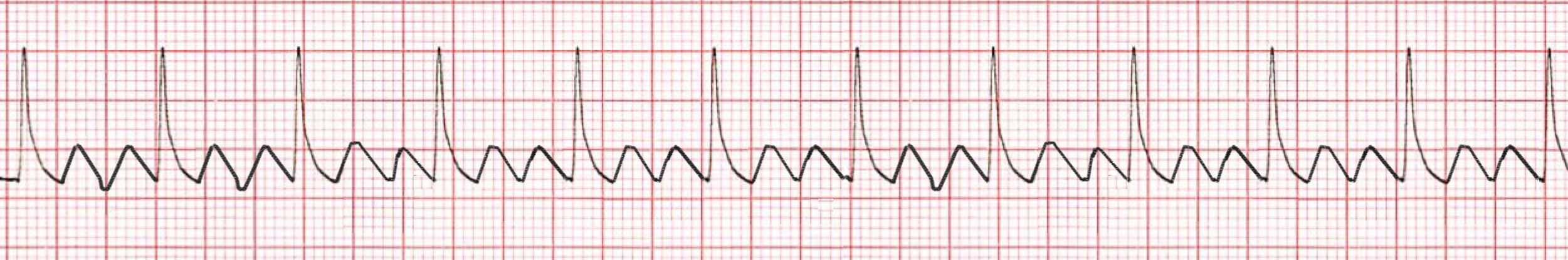 Atrial Flutter Training Cardiac Arrhythmias Video ProPALS