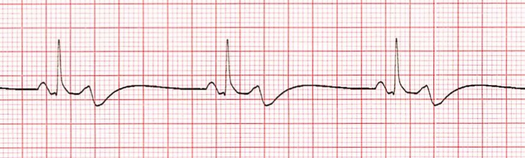 Bradycardia Training ACLS Cardiac Rhythms Video ProACLS Bradycardia Training ACLS Cardiac Rhythms Video ProACLS